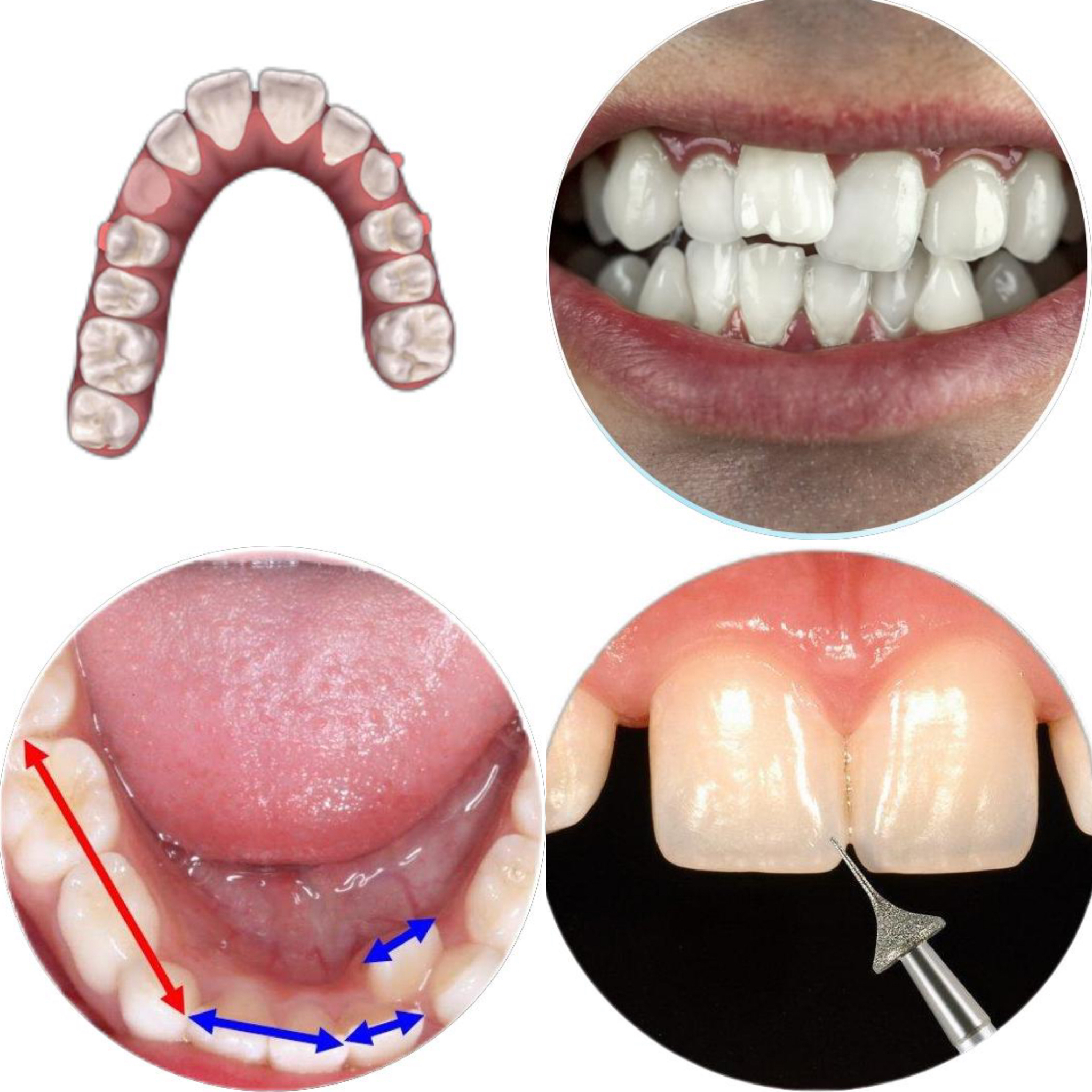 "New Breakthrough in Orthodontics: Minimal Invasion to Balance Teeth ...
