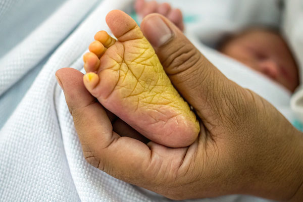 Neonatale geelzucht begrijpen: oorzaken, risico&s en behandeling