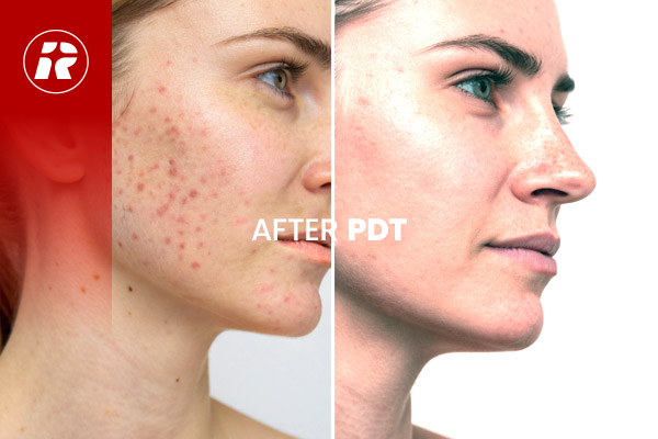 Photodynamic Therapy (PDT): Benefits, Disadvantages, Pain & Skin Effects