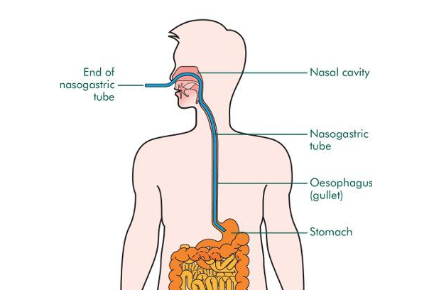 Get to Konw Nasogastric(NG) Tube