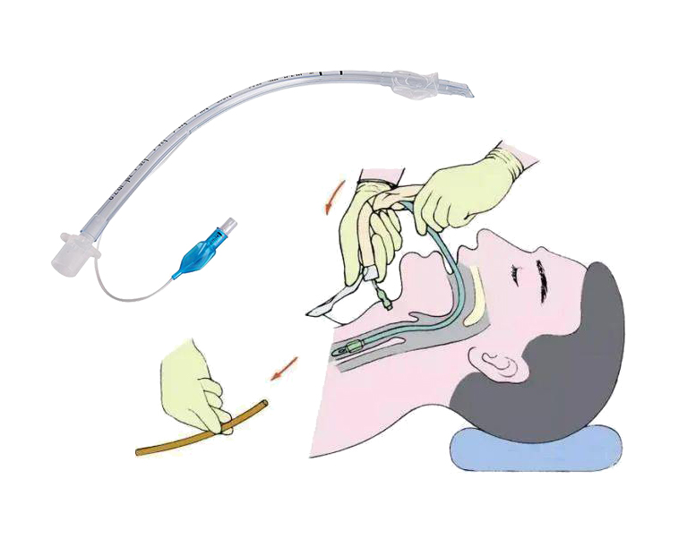 The Secret Weapon of the ICU: Endotracheal Tube That Can Automatically ...