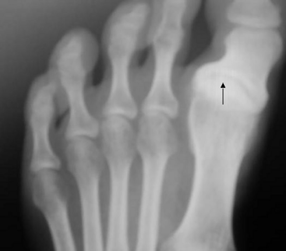 Information About Hallux Varus and How to Correct It | Foot Health